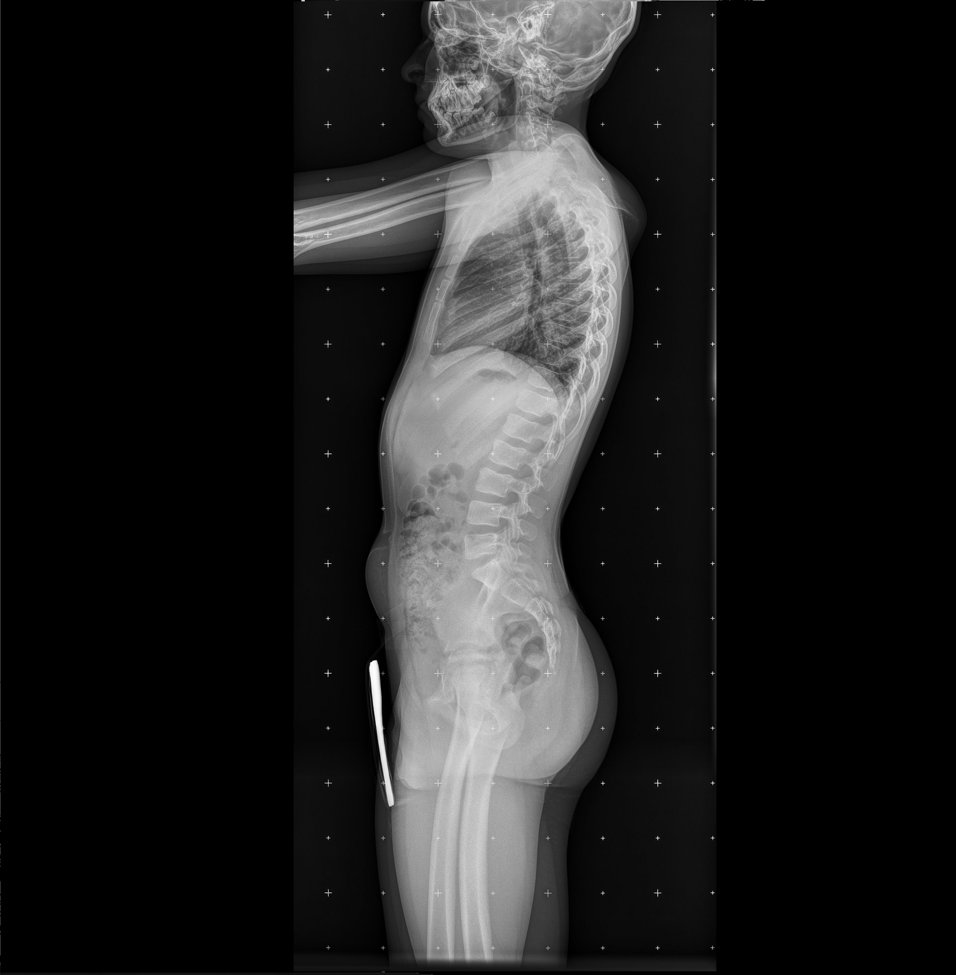 MUSICA™ - Image Processing Software for Digital Radiography