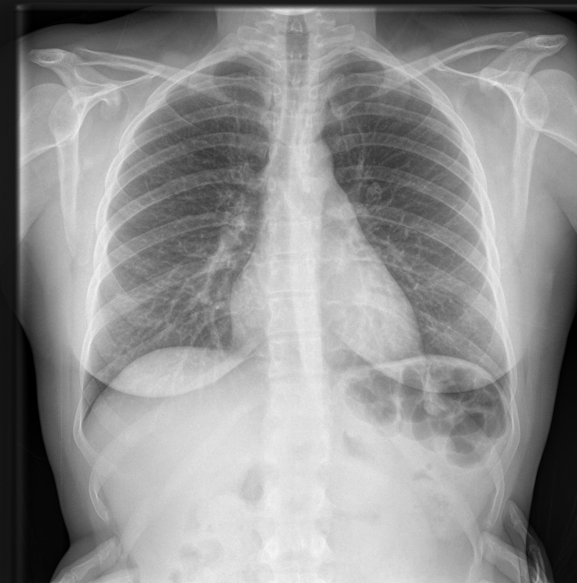 MUSICA™ - Image Processing Software for Digital Radiography