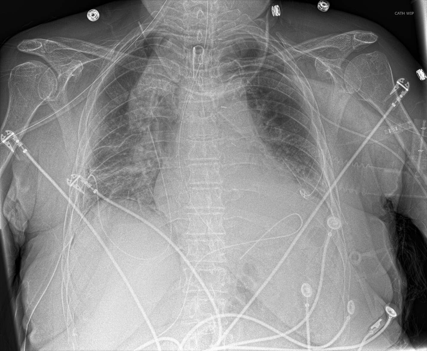 MUSICA™ - Image Processing Software for Digital Radiography