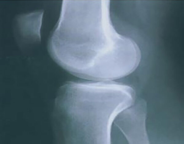 Blue X-ray film - Agfa Radiology Solutions